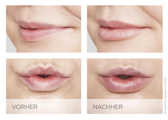 Lippen aufspritzen München » Lippenunterspritzung