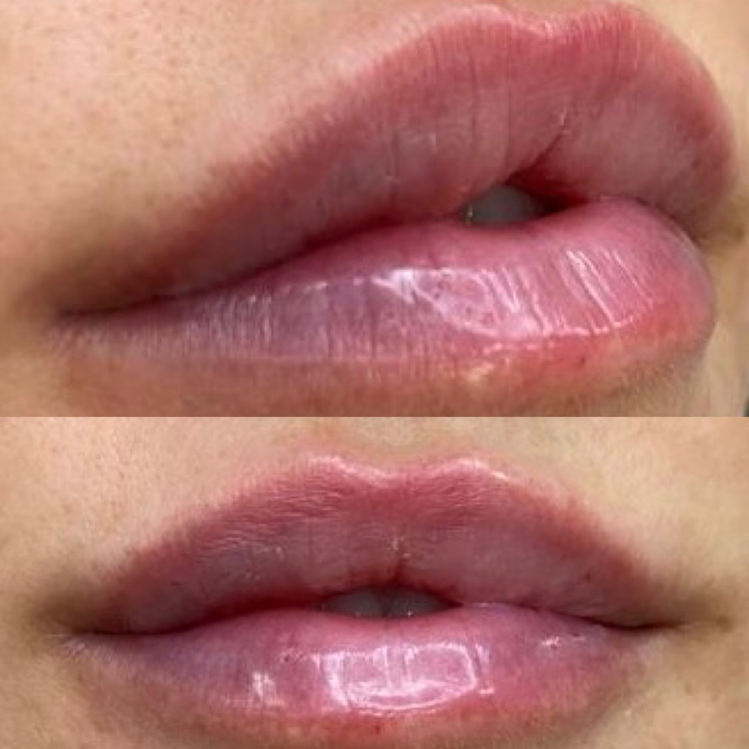 Russian Lips München » sinnliche Lippenvergrößerung mit Filler