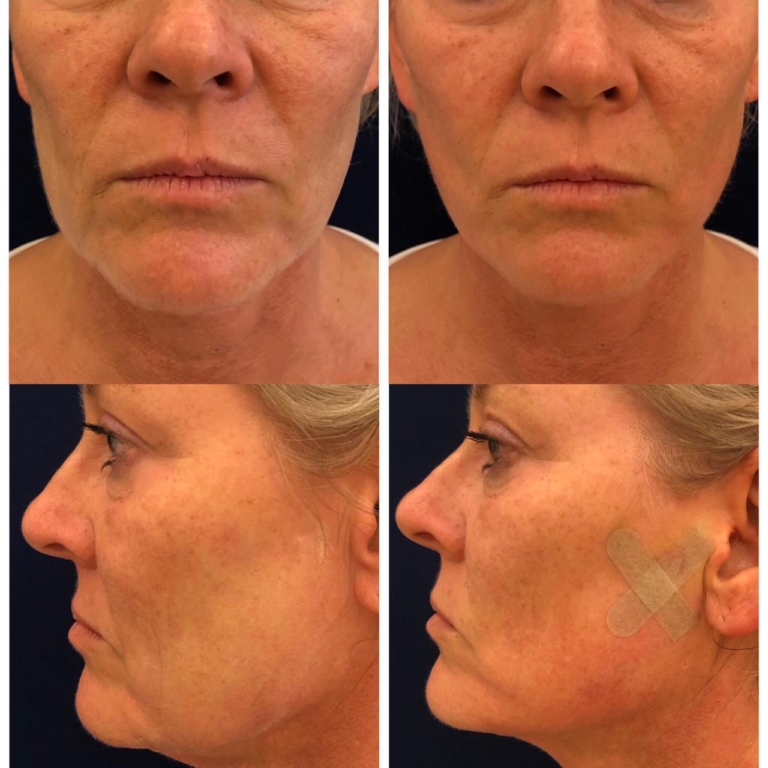 Fadenlifting in München » natürliche straffe Gesichtskonturen